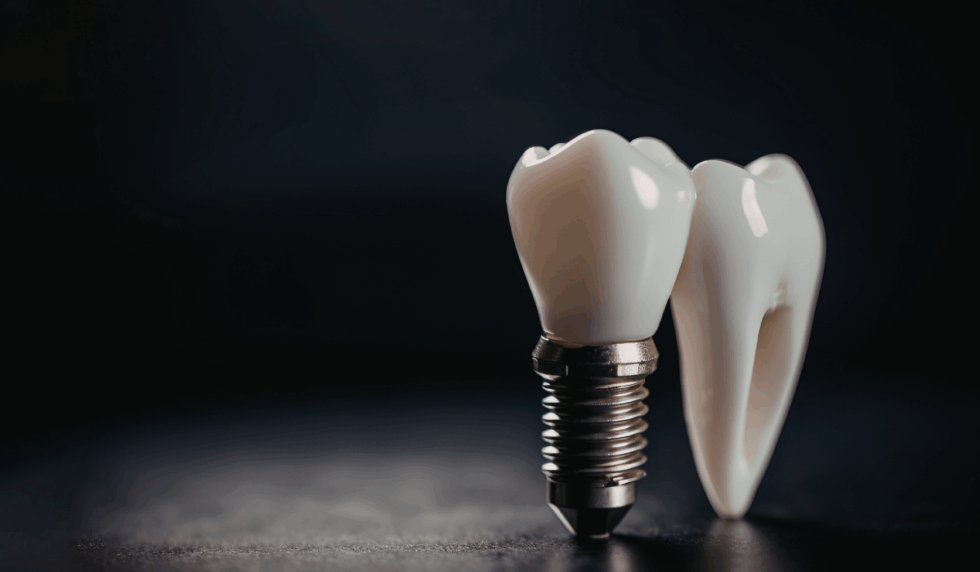 Dental Implants Crown Attachment: The Final Restoration Process ...